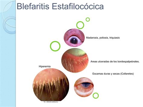 Patología De Párpados Blefaritis Pptx Eye And Vision Conditions