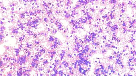 Understanding Monocytosis High Monocytes Causes And Symptoms