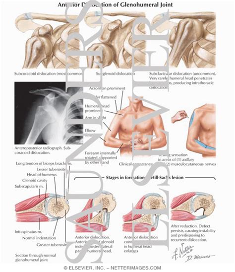 Anterior Dislocation Of Glenohumeral Joint