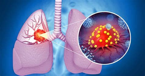 Understanding Small Cell Lung Cancer Treatment Approaches