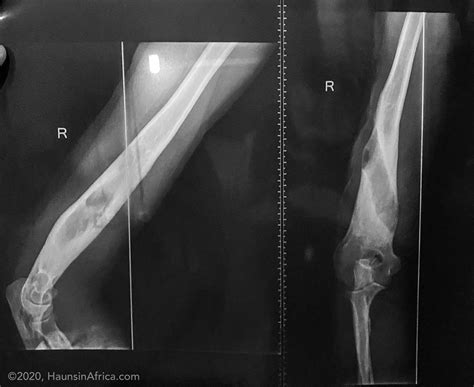 Right Humerus Sequestrectomy The Hauns In Africa