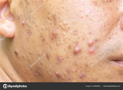 Acne Nodules
