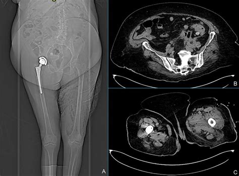 Ct Scan At The Readmission X Ray Showed Marked Improvement Of Left Leg Download Scientific
