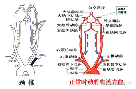 锁骨下动脉盗血综合征 脑医汇