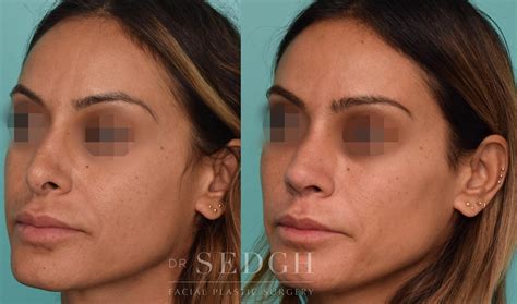 Do Boxers Remove Nose Bone