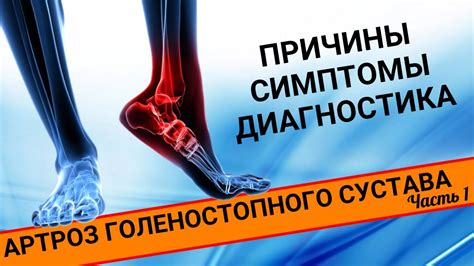 АРТРОЗ ГОЛЕНОСТОПНОГО СУСТАВА Часть 1 Youtube