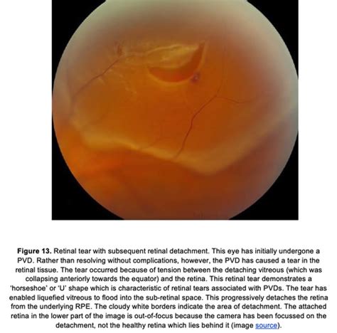 Retinal Detachment Flashcards Quizlet