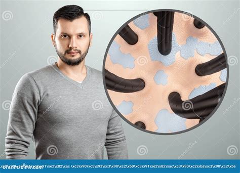 Fungal Disease Of The Skin Dandruff On The Scalp An Enlarged Image Of The Hair And Scalp