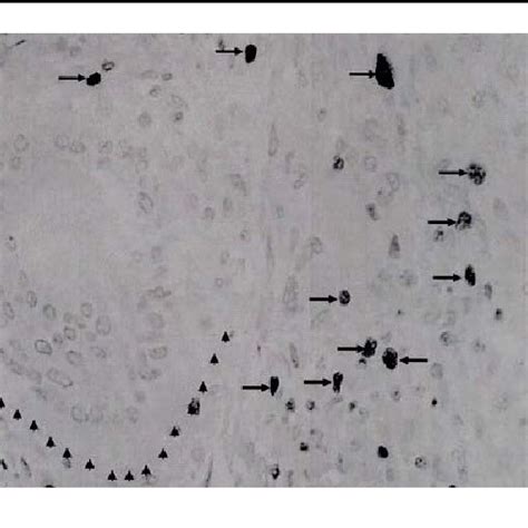 proliferation index pi demonstrated by ki 67 positive cells note the
