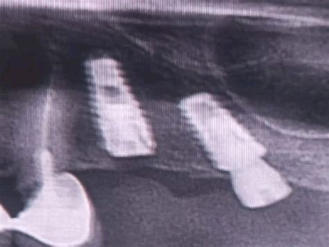 Drmuhammad Ahmad On Linkedin Dentalimplant Dentist Dentistry