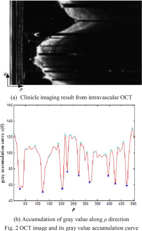 Figure 2 From An Automatic Stent Detection For Intravascular Optical Coherence Tomographic