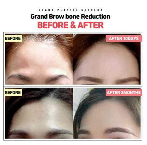 Brow Bone Reduction