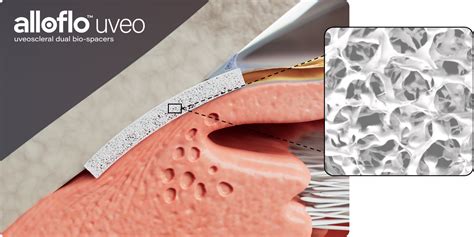 Iantrek Raises 42 Million Series C To Launch Alloflo™ Uveo A