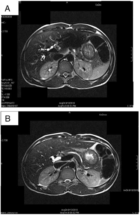 Figure 2 From Igg4 Associated Ampullitis And Cholangiopathy In Crohns