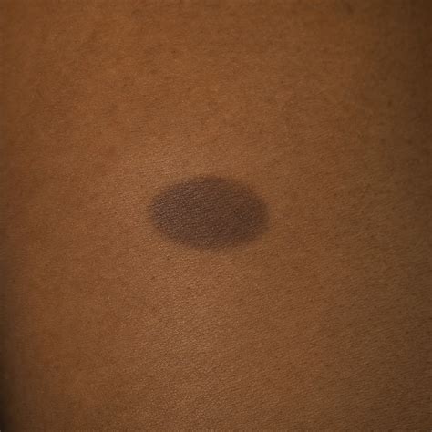 What Do Stds Look Like On Black Skin Std Rapid Test Kits