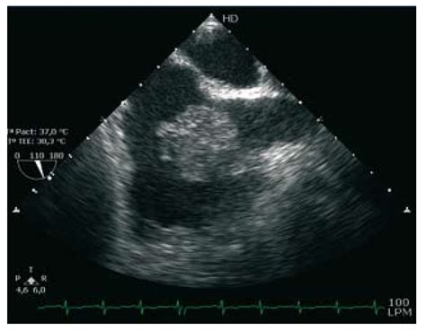 Clinical Variations Of Cardiac Sarcoma Revista Española De Cardiología