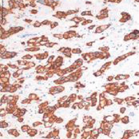 Patterns Of Her2 Ihc Staining A 100 Her2 Ihc Staining B 10 And