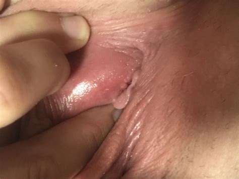 Weird Bumps Sexual Health Forums Patient