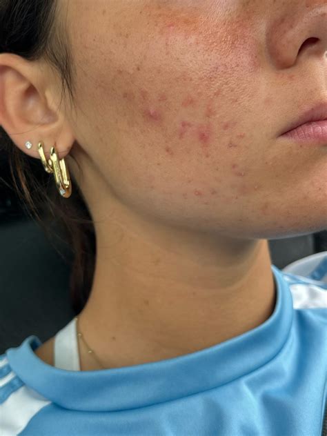 Help What Do I Do To Stop These Red Pimples They R So Inflamed Should