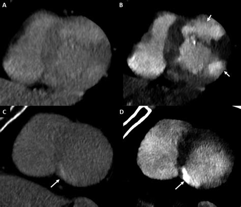 Emerging Role Of Spectral Computed Tomography In Neurocardiology Diagnóstico Journal