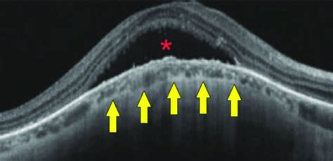 Optical Cut By Sd Ocd Showing Dsm Yellow Arrows With Foveal Serous