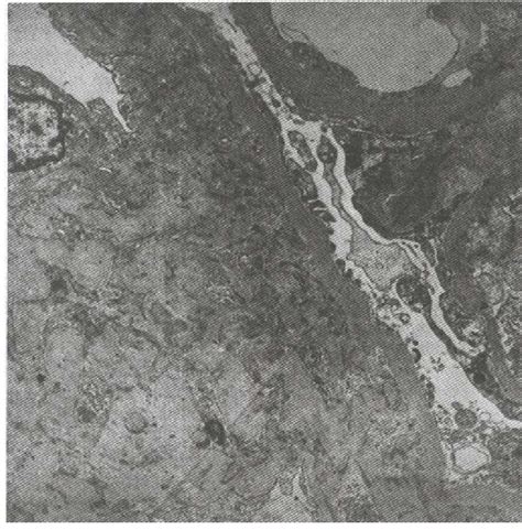 Gross Thickening Of The Glomerular Basement Membrane And Increased