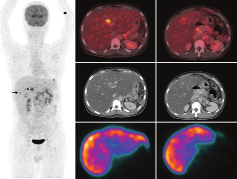 A Image Showing Multiple Foci Of Fdg Uptake In The Abdominal Lymph