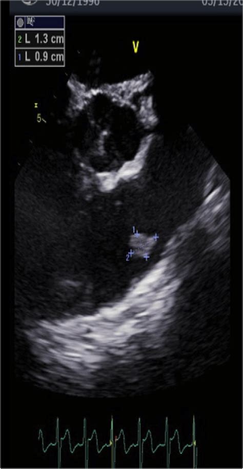 Pulmonic Valve Infective Endocarditis From Staph Lugdunensis Pmc