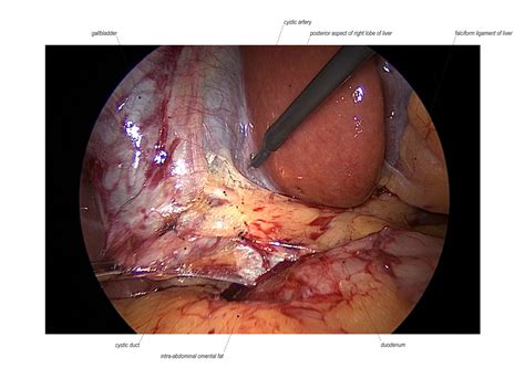 Mini Laparoscopic Cholecystectomy W Ioc Brunt 2017 Surgical Education Learn Surgery