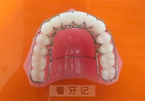 正畸保持器长什么样真实图片附八大注意事项 看牙记网