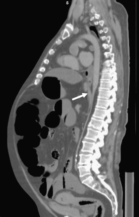 Post Mortem Radiology—a New Sub Speciality Clinical Radiology
