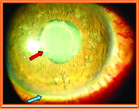 Presence Of Injected Conjunctiva With Fibrin Plaque Around The