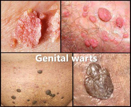 Genital Warts HPV Vs Skin Tags What S The Difference Doctor Zara