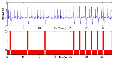 Pvc Detection Based On The Proposed Lhmm Download Scientific Diagram