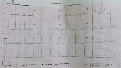 Dr Karen Paul Pereira On Linkedin When We Talk About “tall Tented T Waves” Of Hyperkalemia