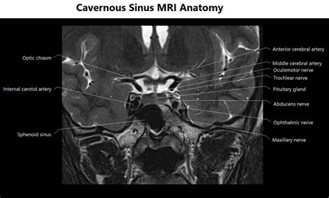 Cavernous Sinus Mri Mri Cavernous Sinus Protocol And Planning