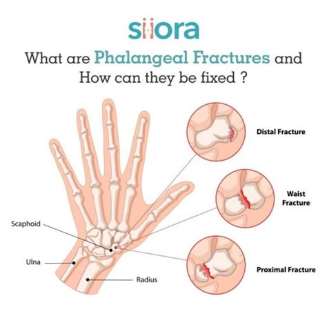 Phalangeal Fractures Causes Symptoms And Treatment