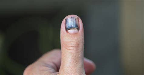 Hematoma Vs Hemorrhage Chart Similarities Differences