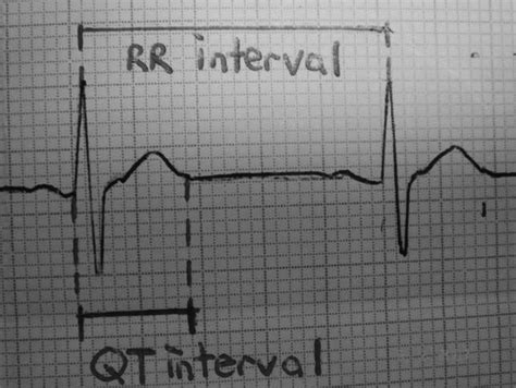 ECG Of A Patient With Short QT Interval QT Interval 0 342 Second RR Download Scientific