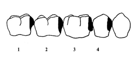 Amalgam Carving Steps For Class Ii Amalgam Restoration Week 2 Flashcards Quizlet