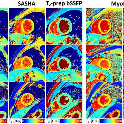 Comparing Myofold Joint T1 And T2 Maps Of Four Subjects To Those By Download Scientific Diagram