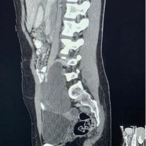 Ct Image Sagittal View Showing The Retroperitoneal Mass Displacing Download Scientific