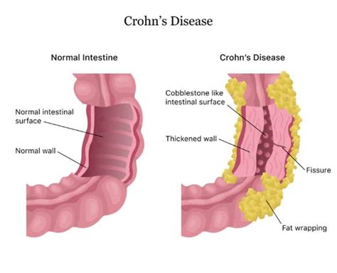 Comprendre La Maladie De Crohn Un Facteur De Risque Pour Le Cancer