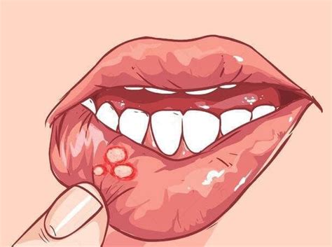 Афти причини и натурални начини за лечение Mouth Ulcers Causes Of