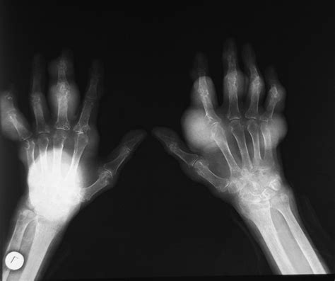 Chronic Tophaceous Gout The Journal Of Rheumatology