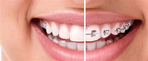 Orthodontics Braces Whitecoats Clinic
