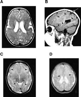 Brain Development And The Genetics Of Brain Development Neurologic