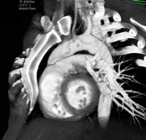 Focal Superior Mesenteric Artery Sma Dissection Vascular Radiology