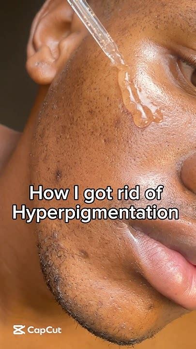 How I Got Rid Of My Hyperpigmentation Hyperpigmentation Enlargedpores