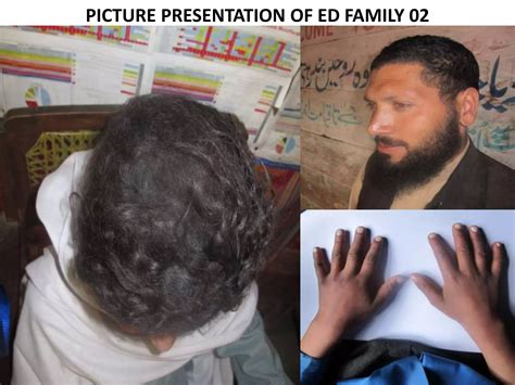 Ectodermal Dysplasias Genetic Disorder Pptx